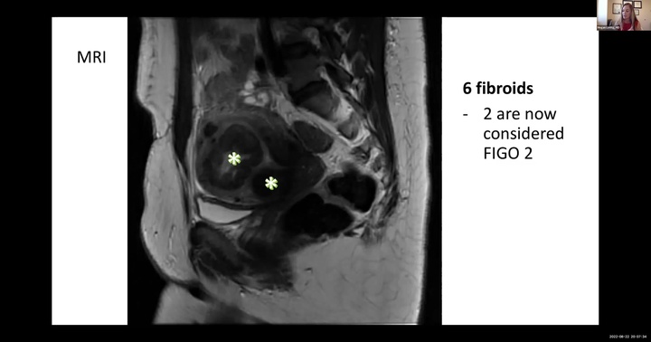 Intrauterine Surgery for AUB-L: Resectoscopic Techniques - SurgeryU by AAGL