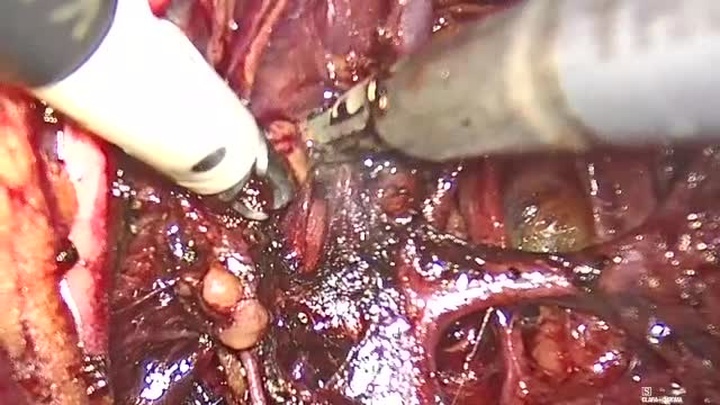 Deep Infiltrating Endometriosis of the Left Sciatic Nerve Combined ...