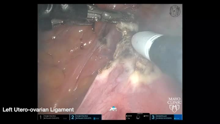 Single Port Robotic Fibroid Hysterectomy - SurgeryU by AAGL