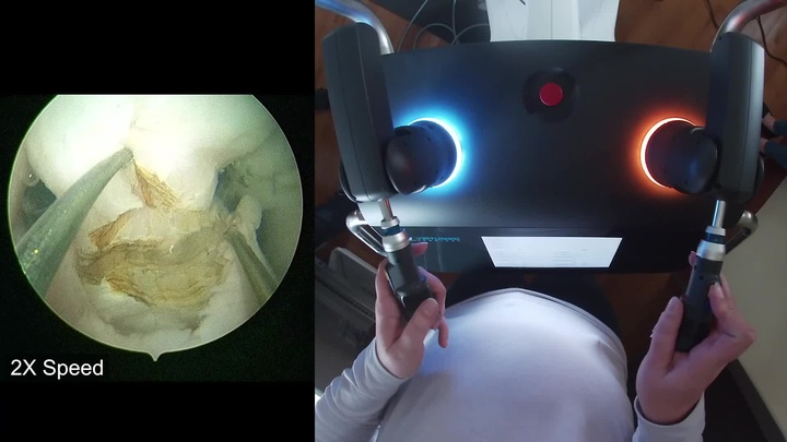 Hysteroscopic Multiple Myomectomy: Robotic Endoscope Update - SurgeryU ...