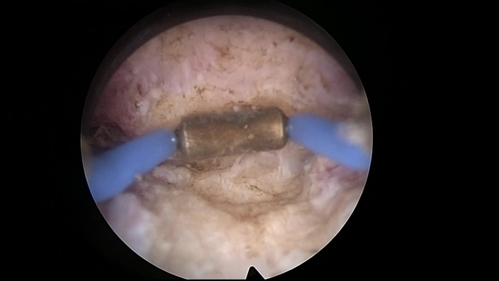 Complete Longitudinal Vaginal Septum Resection and Hysteroscopic ...