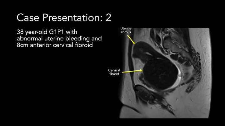 Navigating Cervical Fibroids during Laparoscopic Hysterectomy ...