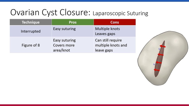 The Lightning Bolt: A Simplified Laparoscopic Closure Technique after ...