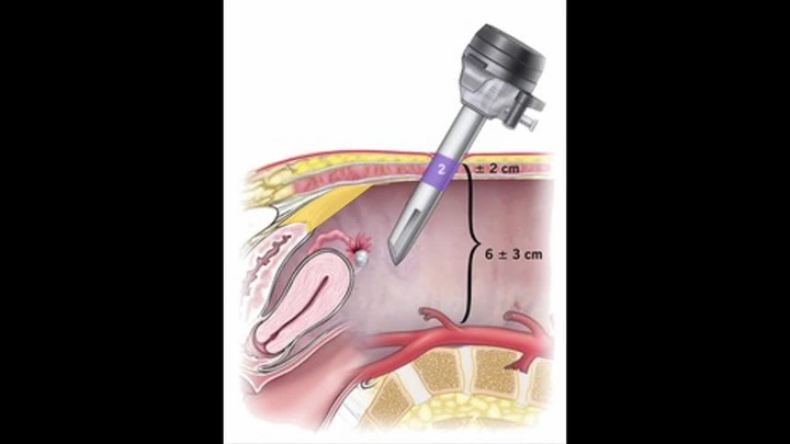 Surgical Management of Isolated Fallopian Tube Torsion in the Pediatric ...