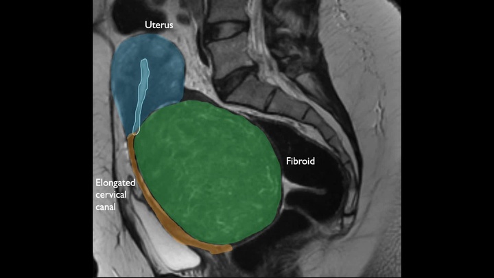 Laparoscopic Cervical Myomectomy Techniques - SurgeryU by AAGL