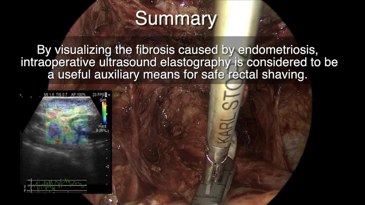 Intraoperative Ultrasound Elastography Guided Rectal Shaving for ...