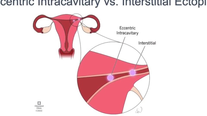 Multidisciplinary Approach to the Surgical Management of Interstitial ...