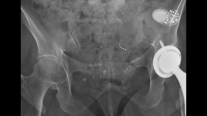 A Novel Technique for Removal of Intravesical Foreign Body - SurgeryU ...