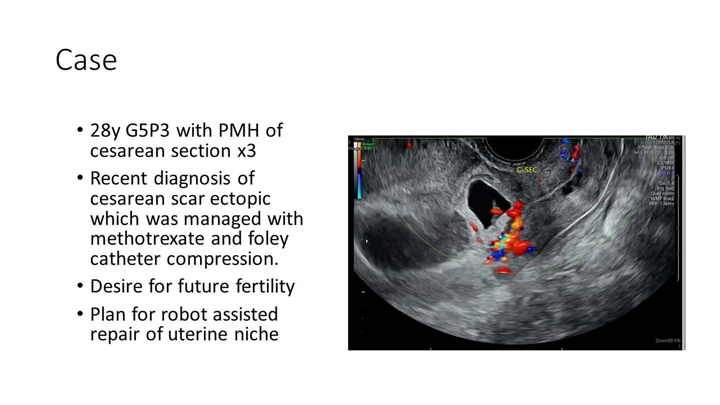 Hysteroscopic and Robotic Assisted Laparoscopic Repair of Uterine Niche ...