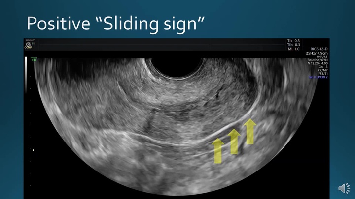 The “Triangle Sign”: A Novel Dynamic Ultrasound Technique for ...