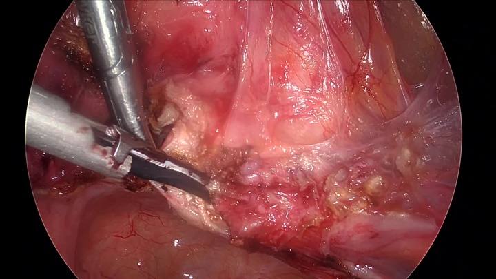 MIGS Fellows (Put a Ring on It) Laparoscopic Upper Vaginectomy ...