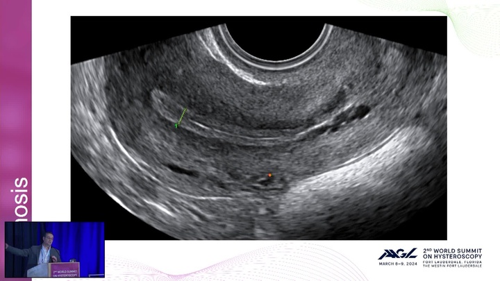 SATURDAY-01-Hysteroscopic Management of Retained Products of Conception ...