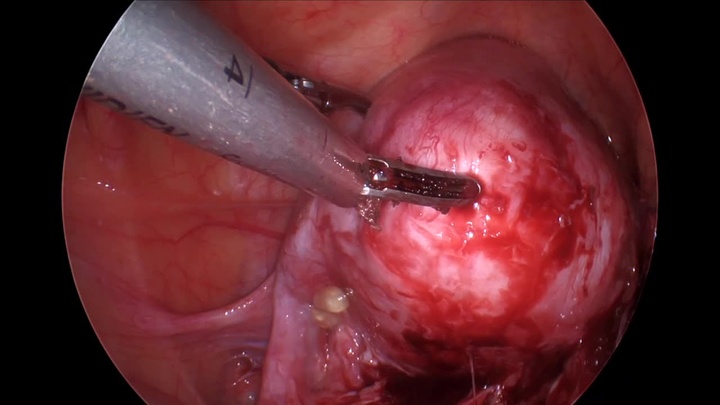 Laparoscopic Excision of Adenomyoma - SurgeryU by AAGL
