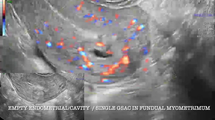 Intramyometrial Pregnancy - SurgeryU by AAGL