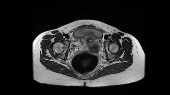 Enhancing Myomectomies with 3D Uterine Modeling - SurgeryU by AAGL