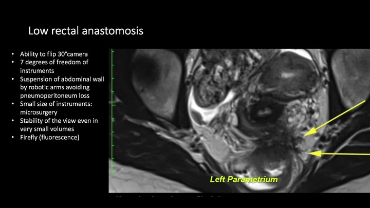 Sciatic Nerve Schwannoma: Complete Excision Using Robotic Assistance ...