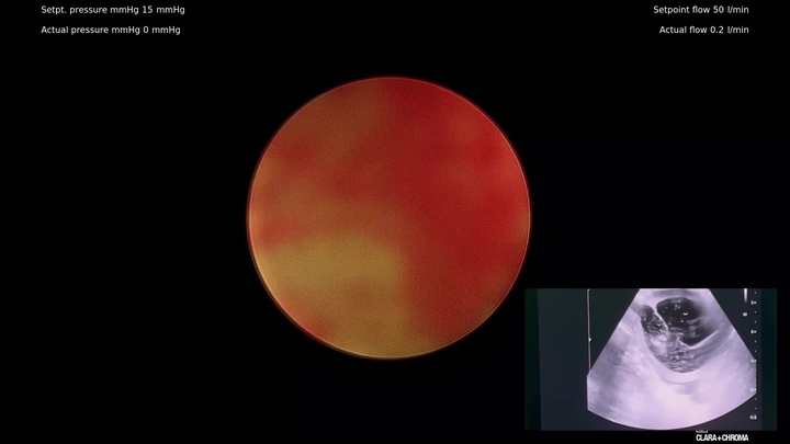 Hysteroscopic Resection of Early Pregnancy Loss - SurgeryU by AAGL