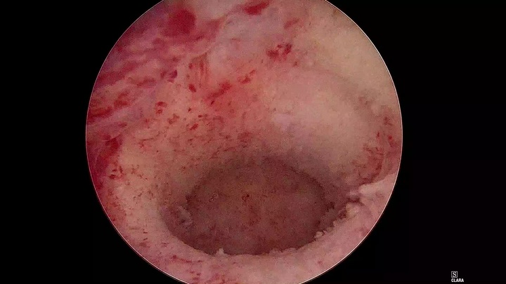 The Use of Hysteroscopy During Robotic Repair of a Uterine Niche ...