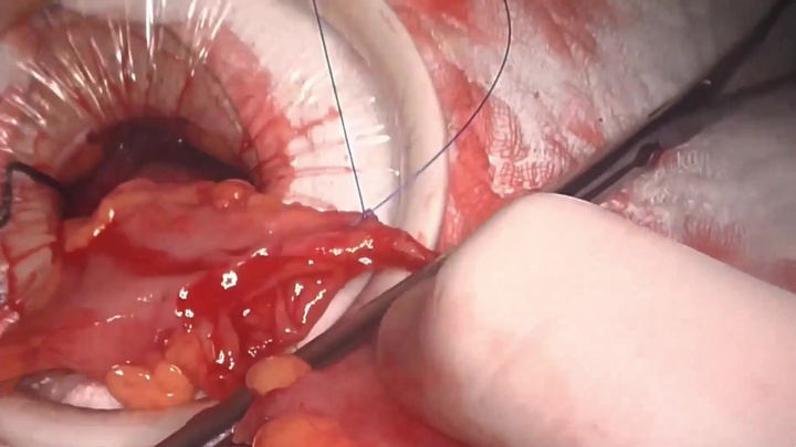 Multiple Approaches to Avoid a Colostomy in Bowel Endometriosis Surgery ...