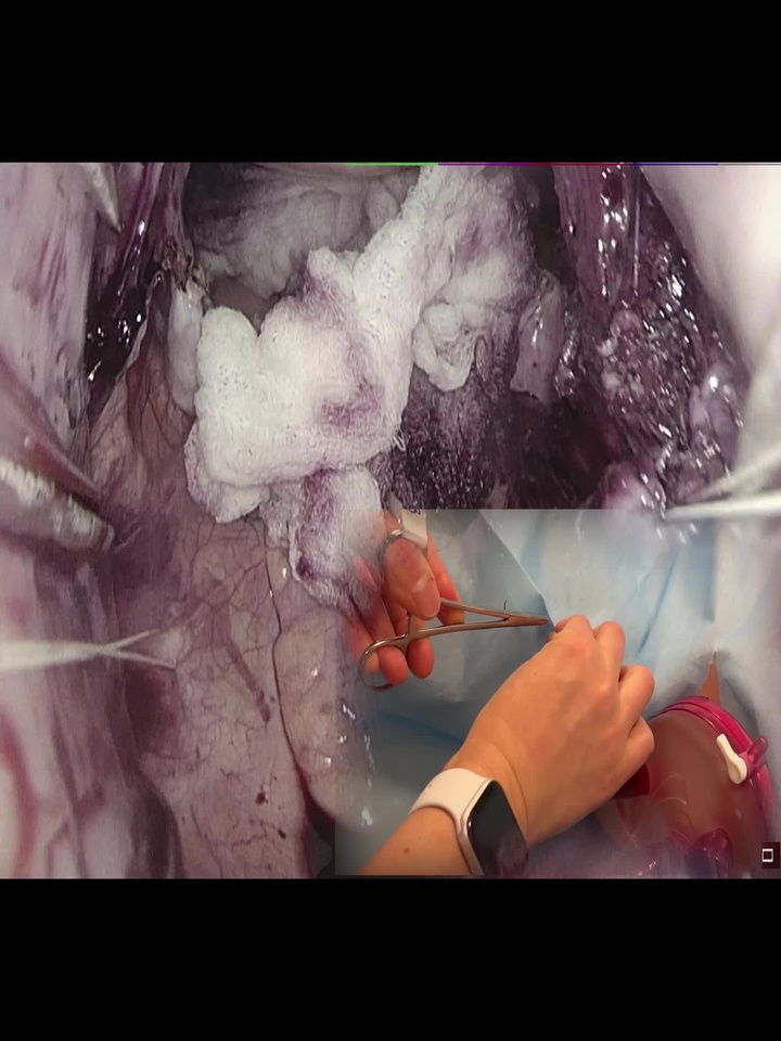 vNOTES Uterosacral Ligament Suspension; Staying Organized - SurgeryU by ...