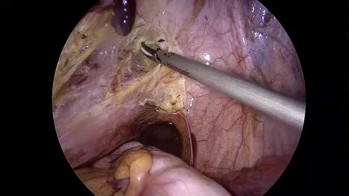 The Butterfly Method: Peritonectomy for Superficial Endometriosis - SurgeryU by AAGL