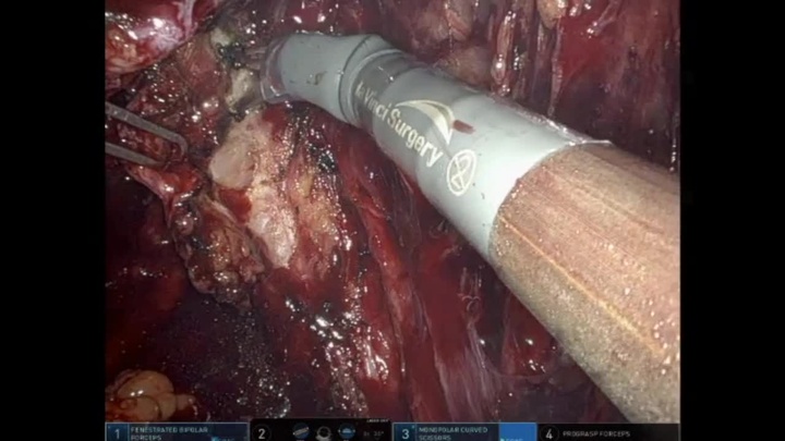 Endometriosis SIG: A Challenging Case Due to Previous Incomplete ...