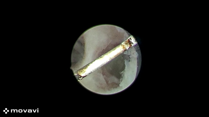 Hysteroscopic Retrograde Septoplasty - SurgeryU by AAGL