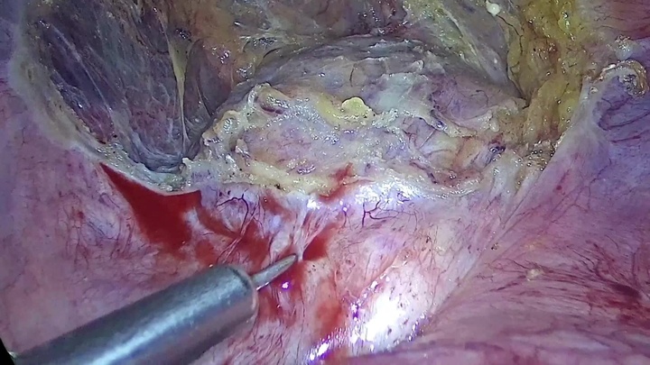 Laparoscopic Approach to a Cesarean Scar Pregnancy - SurgeryU by AAGL