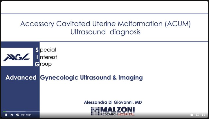 Accessory Cavitated Uterine Malformation (ACUM) Ultrasound Diagnosis ...