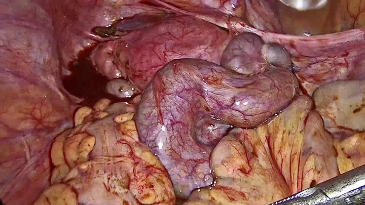 Deep Infiltrating Endometriosis with Rectal Shaving - SurgeryU by AAGL