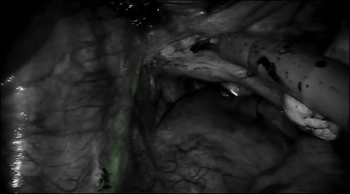 Assessing Ureteral Location in FireFly Fluorescence Imaging Mode During ...