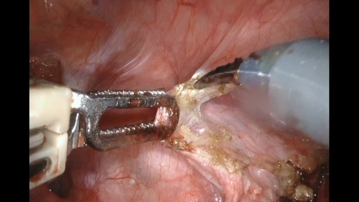 Upper Vaginectomy for Fibroid Recurrence at the Vaginal Cuff in a ...