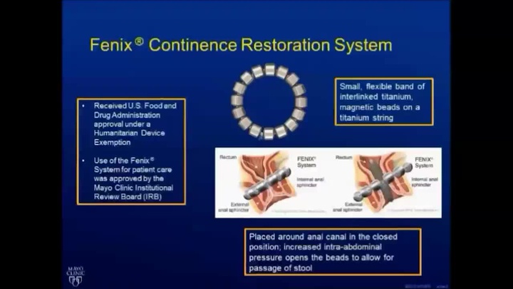 The Fenix System for Fecal Incontinence: An Overview and Surgical ...