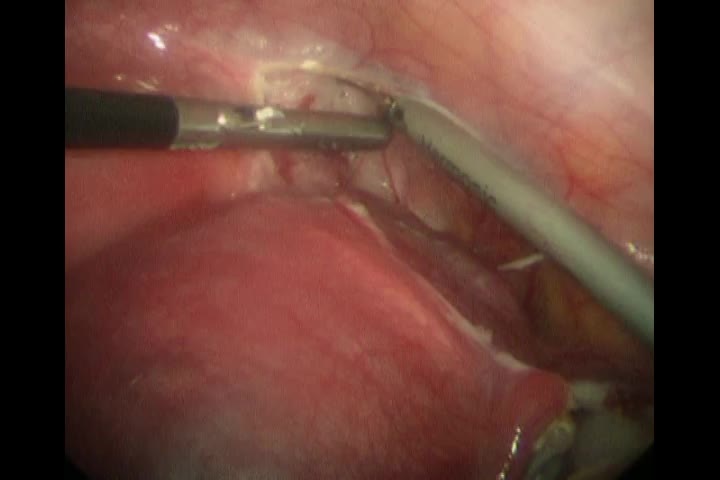 Laparoscopic Management of a Rudimentary Horn Pregnancy - SurgeryU by AAGL