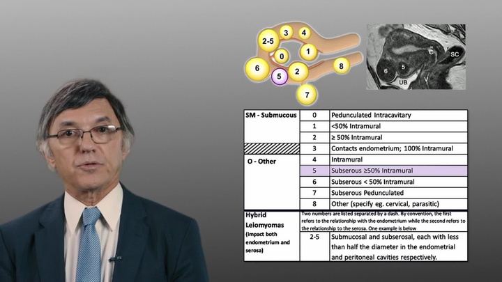 FIGO Leiomyoma Subclassification System - SurgeryU by AAGL