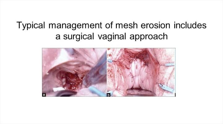 A Novel Vaginoscopy Technique for Repair of a Vaginal Mesh Erosion - SurgeryU by AAGL