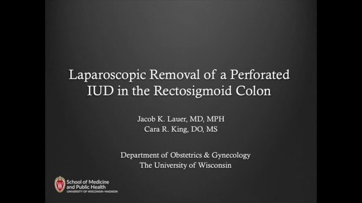 Laparoscopic Removal of a Perforated IUD in the Rectosigmoid Colon ...