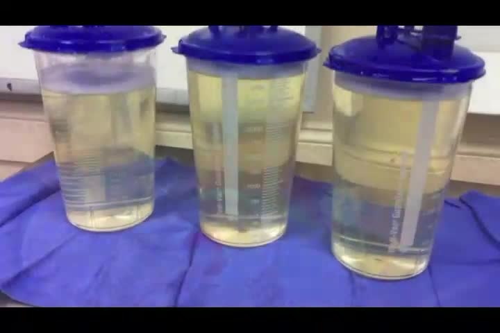 Minimally Invasive Approach to a Large Pelvic Mass - SurgeryU by AAGL