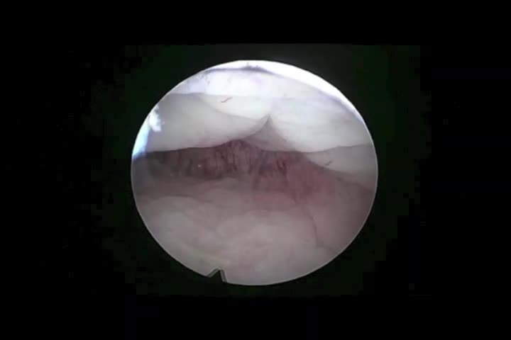 Combined Laparoscopic and Hysteroscopic Approach to a Cervical Ectopic ...