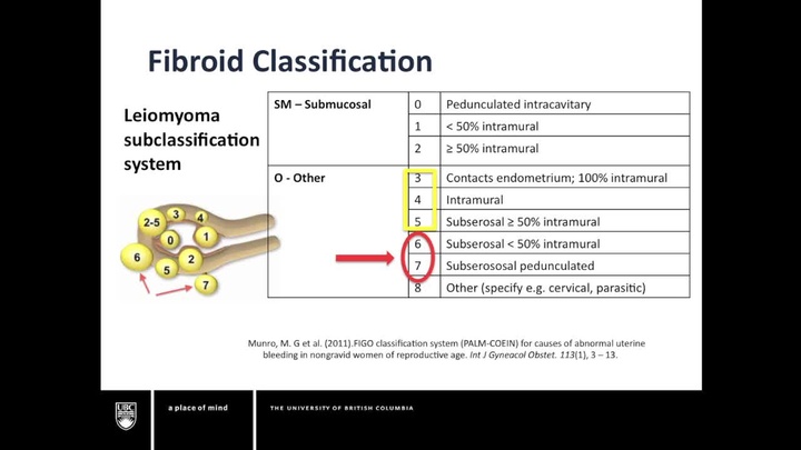 Combined Medical and Surgical Approach to Symptomatic Fibroids with ...