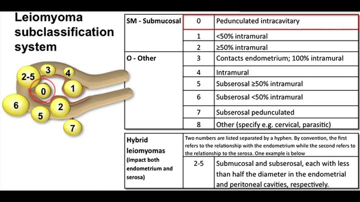 Submucosal Resection of at Type 2 Myoma by Hysteroscopic Morcellation ...