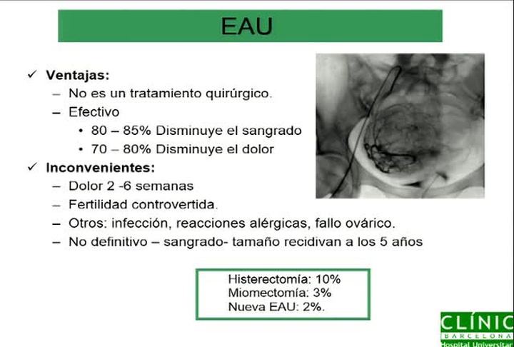 Tratamiento Medico del Mioma y Otros Tratamientos No Quirurgicos ...