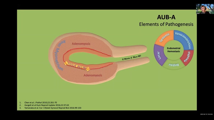 Approach to the Workup of AUB with the Focus on Nonsurgical/Hormonal ...