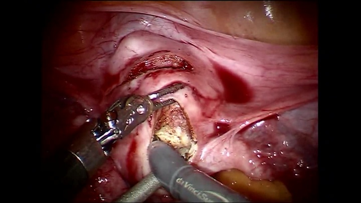 Laparoscopic Ultrasound During Robotic Myomectomy - SurgeryU by AAGL