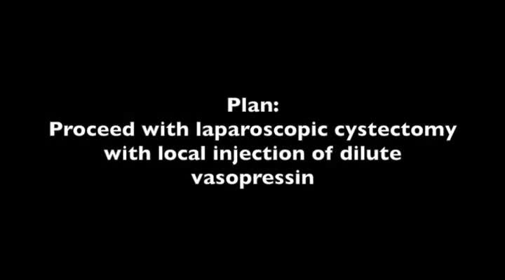 Cyst Removal With Dilute Vasopressin - SurgeryU by AAGL
