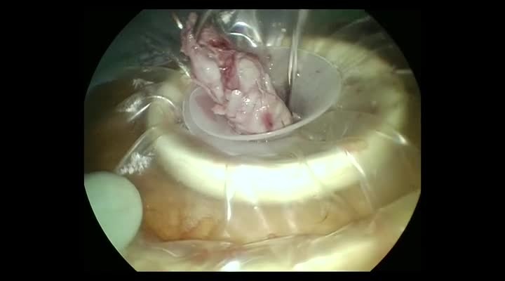 Contained Hand Morcellation in a Novel FDA-Approved Bag - SurgeryU by AAGL